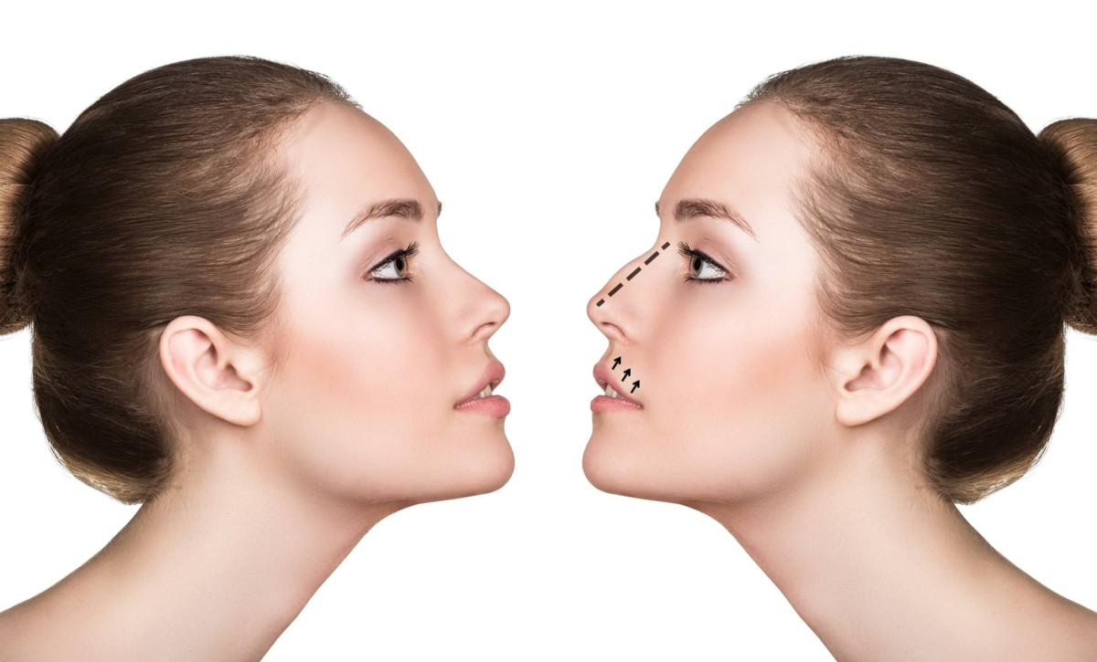 A Quick Guide to Different Types of Rhinoplasty Procedure - Dr. Wolf